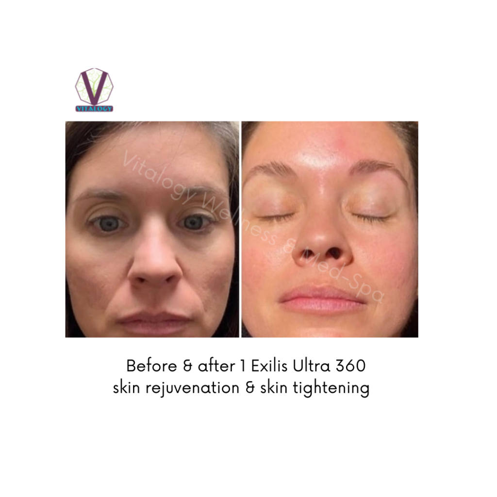 Exilis Ultra Skin Tightening - Vitalogy Wellness Center